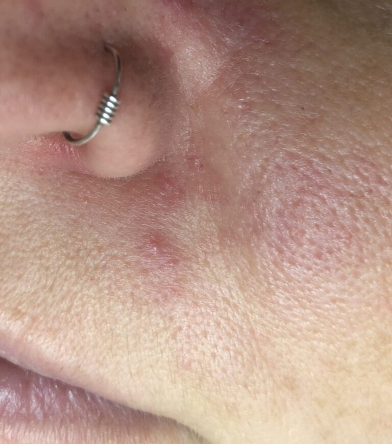 Periorale Dermatitis: 5 Tipps wie Du die Mundrose besiegst! | kosmedik