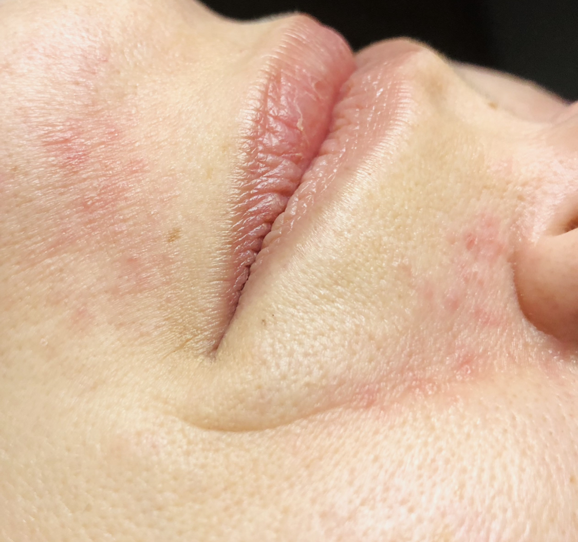 Periorale Dermatitis: 5 Tipps wie Du die Mundrose besiegst! | kosmedik